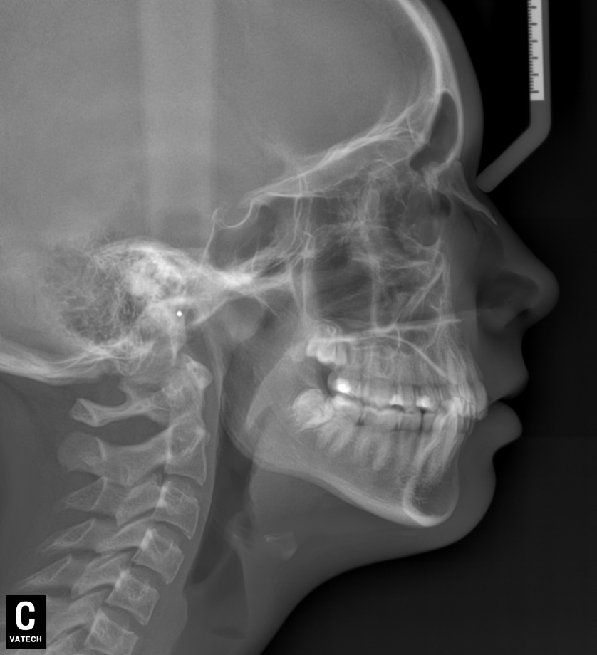 Rentgen zębów - Łódź Widzew - Duodent NZOZ Arkadiusz Polakowski