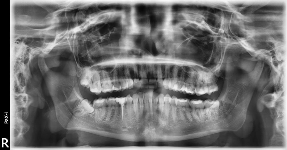 Rentgen zębów, zdjęcia pantomograficzne - Łódź | Duodent