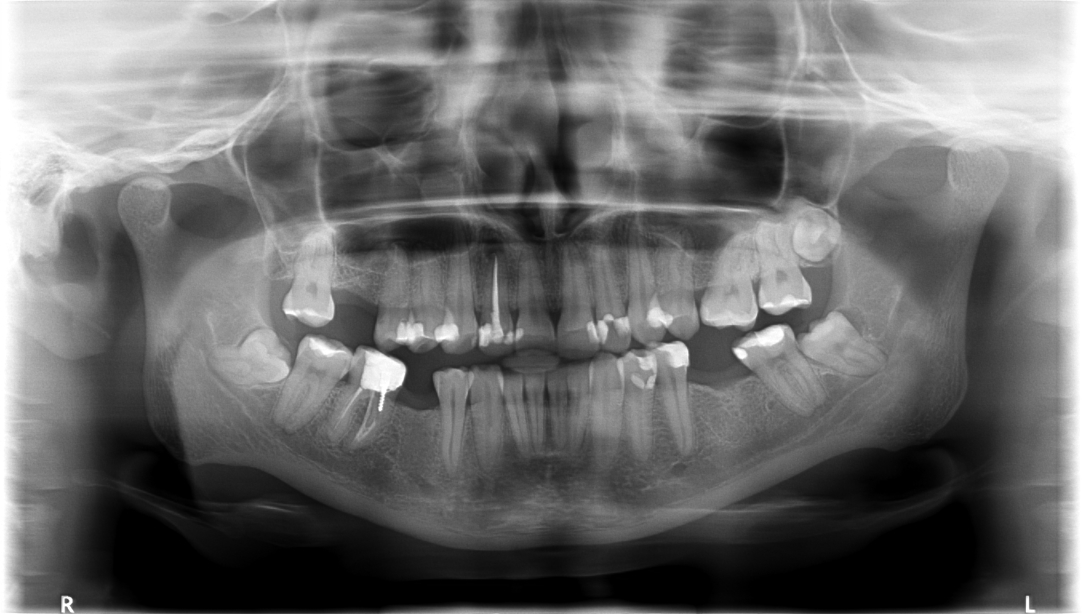 Rentgen zębów - stomatologiczny